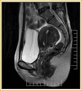 Endometriosis-MRI - Sumer's Radiology Blog
