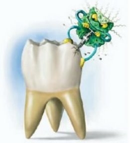 Seminario 6: Caries: CARIES RESIDUAL
