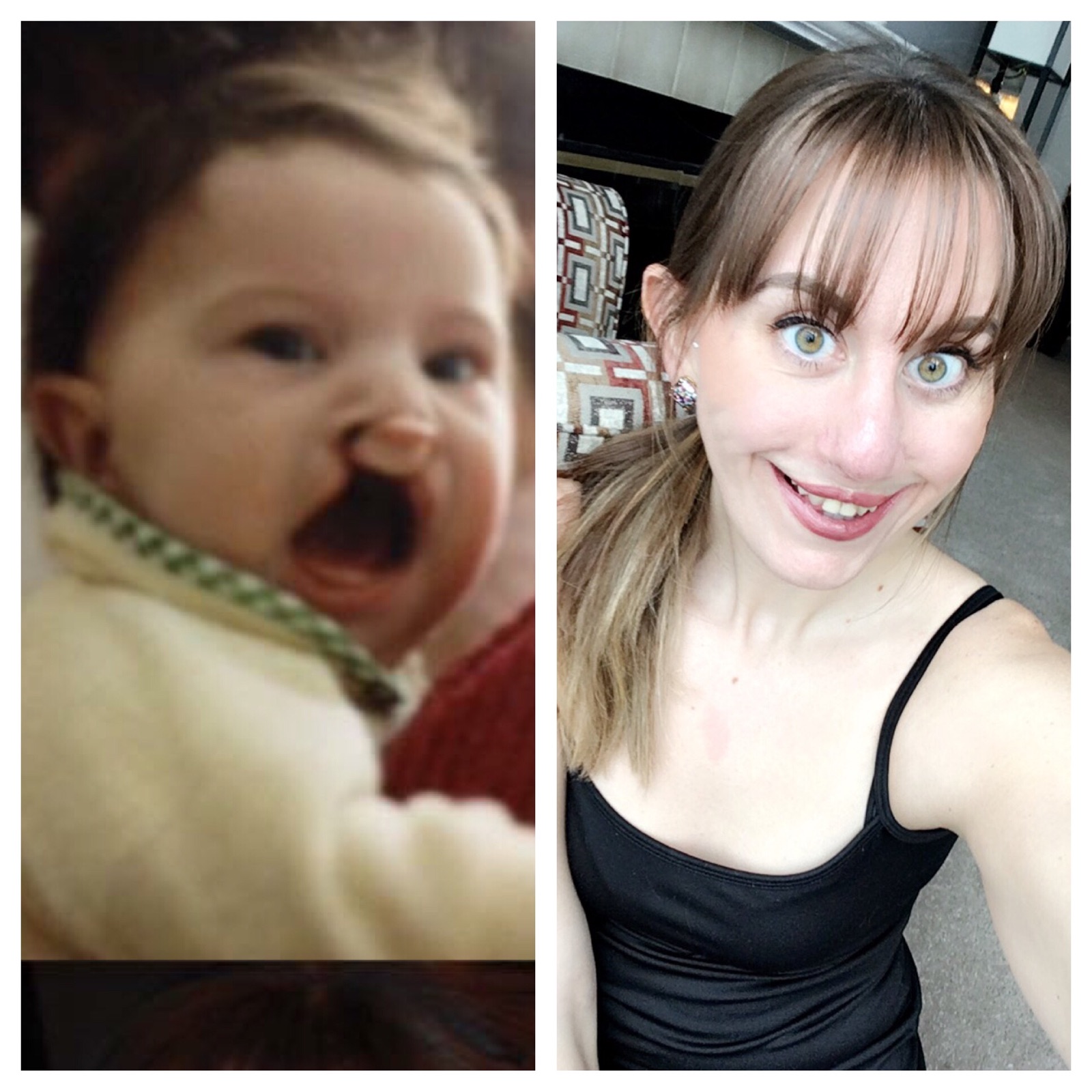 CCA Kids Blog: On Seeing A Baby With An Unrepaired Cleft Lip