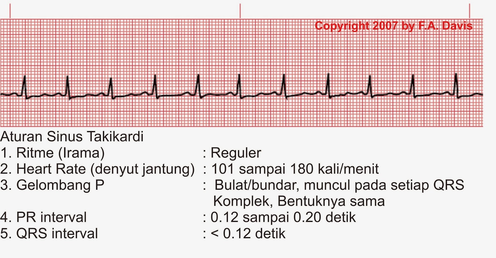 Sinus Tachycardia