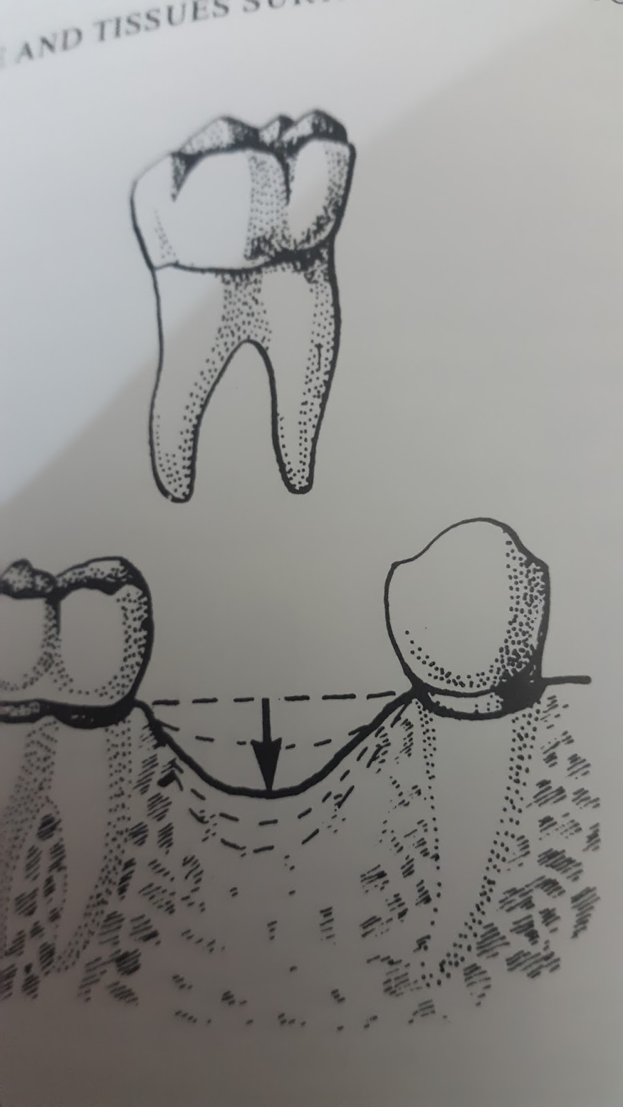 IMPLANTES (hagamoshistoria): THE BONE IS AVAILABLE-WHY NOT USE IT ...