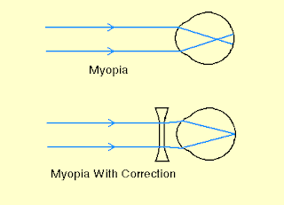 Different types of Eye Problems-How to cure them ~ Teknomenia