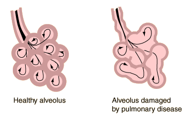 Emphysema: Introduction