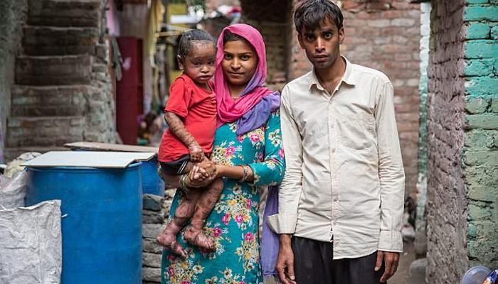 2 year old Indian Girl Suffers From Rare Skin Condition Causing Her To 2-year-old-indian-girl-suffers-from-rare-skin-condition-causing-her-to
