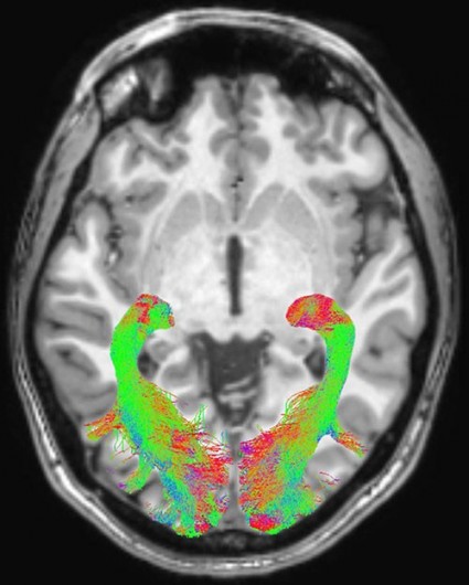 Our Parkinson's Place: Brain MRI Shows Visual System Changes in ...