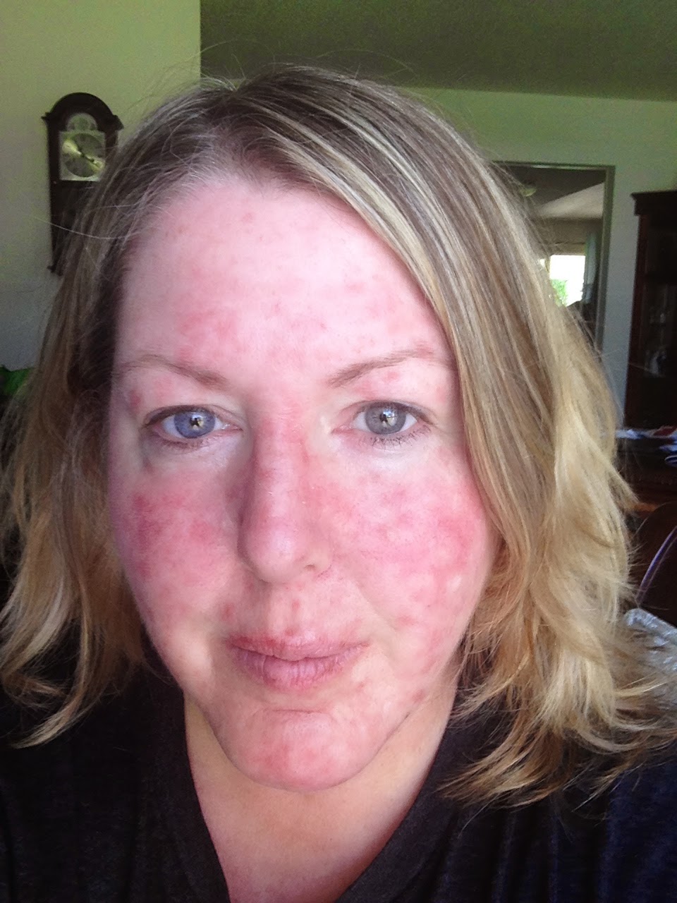 My Journey Through Topical Chemotherapy - Fluorouracil 5% Cream and ...