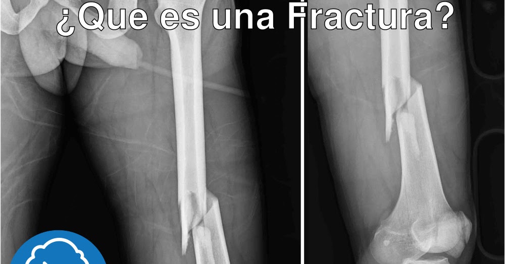¿Que es una Fractura?