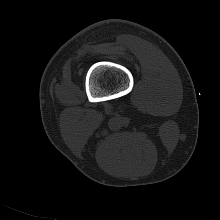 CT Knee - Radiology Imaging