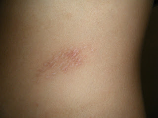 21 and Shingles: Shingles scars