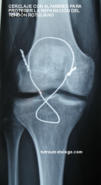 Polo's Notebook: Lesión de Ronald Vargas, explicada