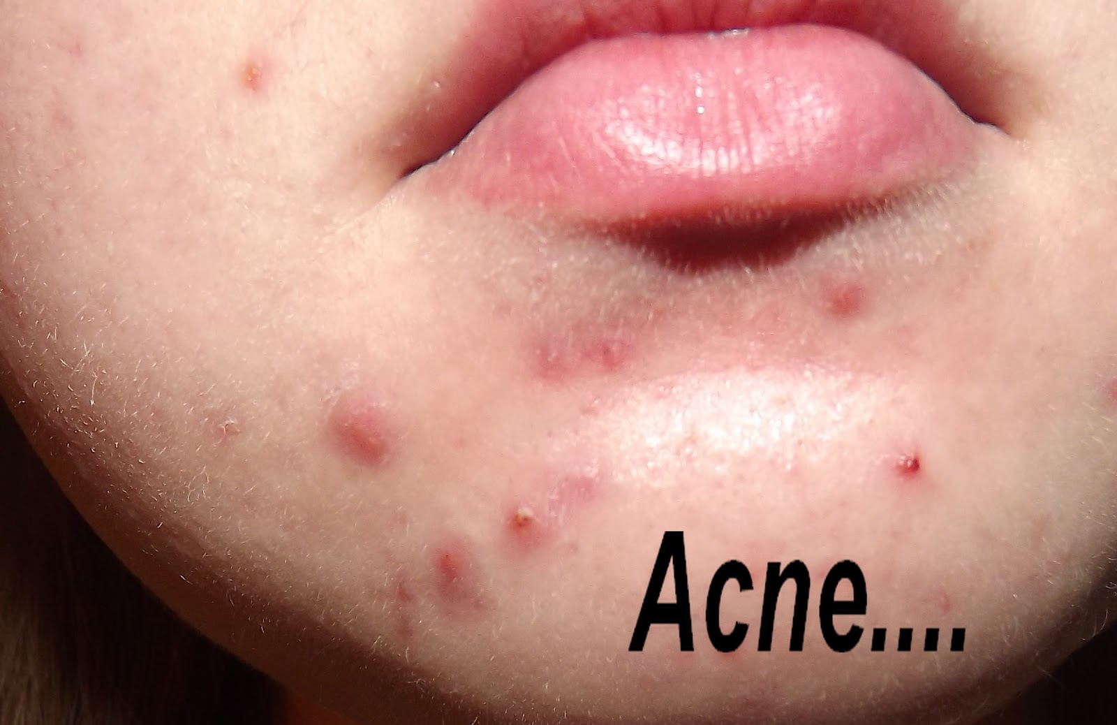 This is our fight.: Metabolic Syndrome Signs and Symptoms.