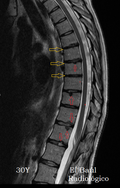 El Baúl Radiológico: ENFERMEDAD DE SCHEUERMANN (DORSALGIA JUVENIL ...