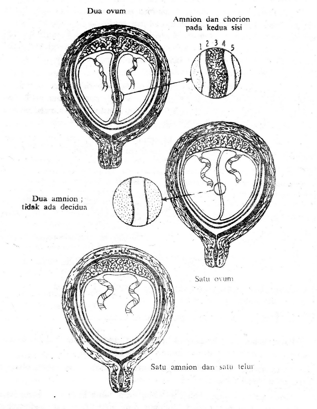 BIDANKU KEREN: KEHAMILAN KEMBAR ( GEMELLI )