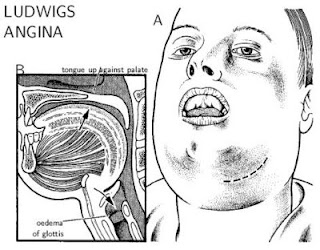 Ludwig's Angina: Ludwig's Angina Therapy Details