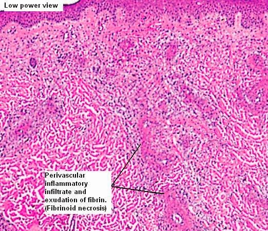 Dermatopathology Case 123