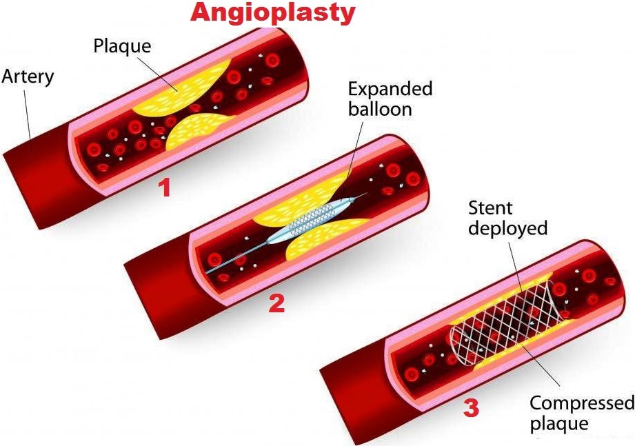 e-Clinic: Angina