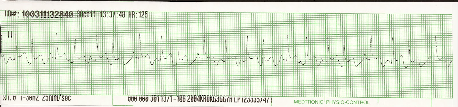 EKG Rhythm Strips 03