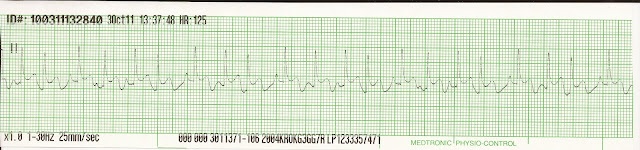 EKG Rhythm Strips 03