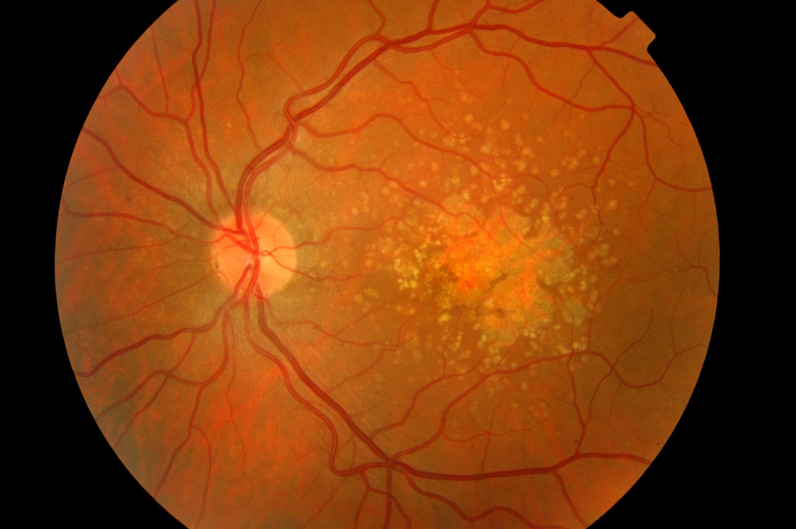 Degeneracion Macular: AMD