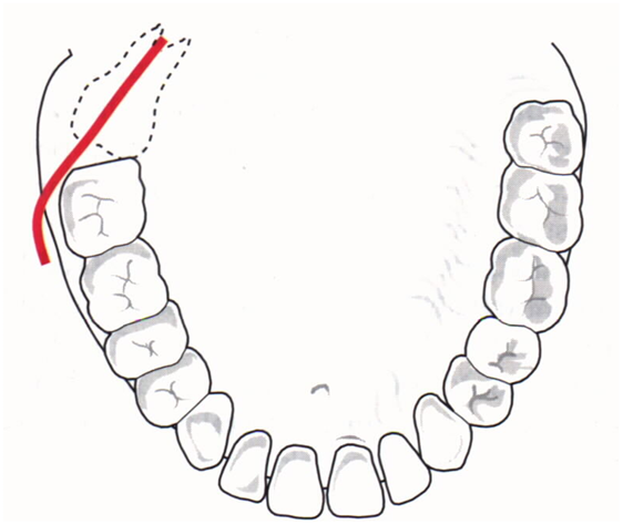 Dentistry and Medicine: Surgical management of Unerupted and Impacted teeth