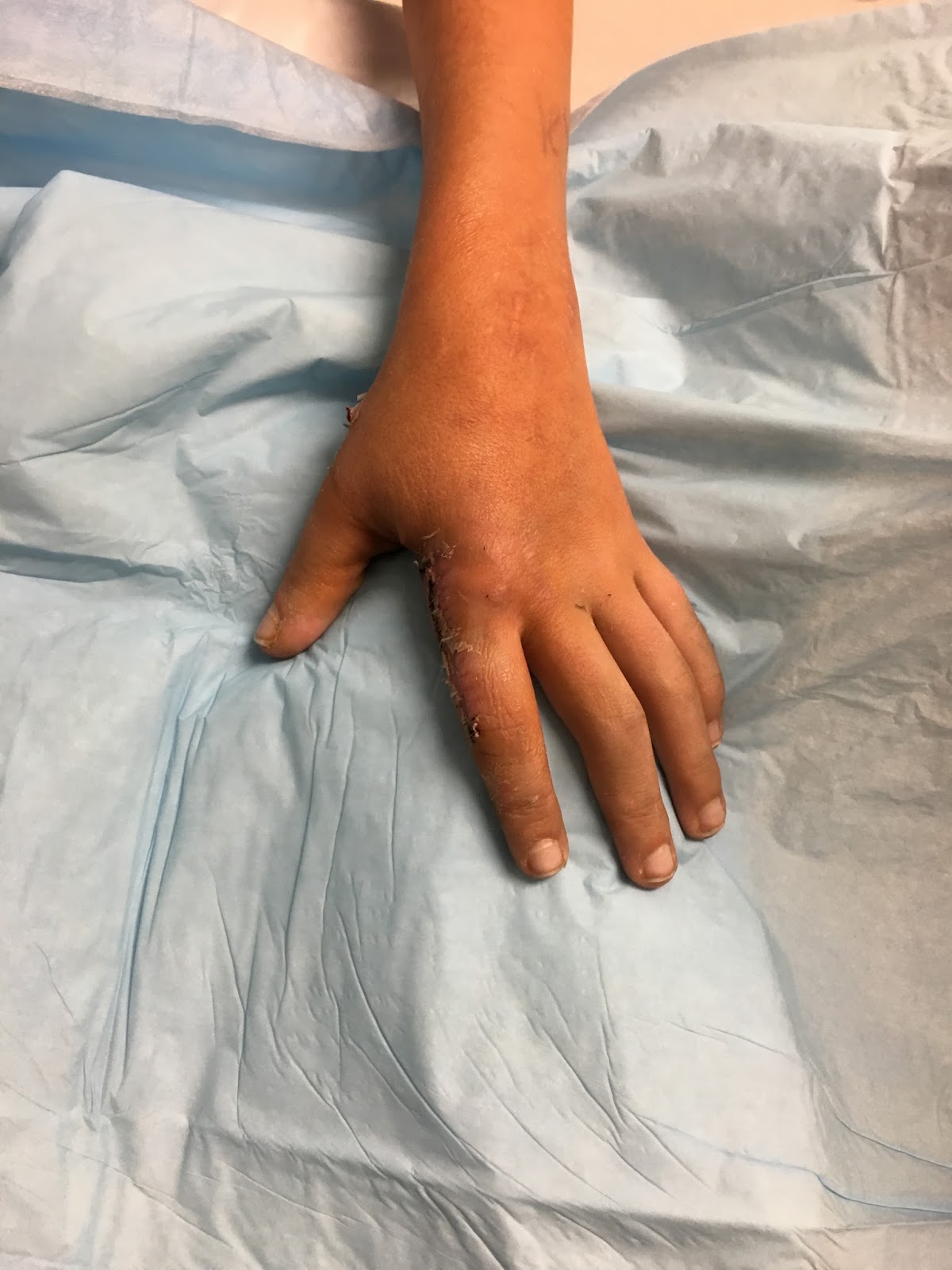 The Arthrogryposis Thumb | Congenital Hand and Arm Differences ...