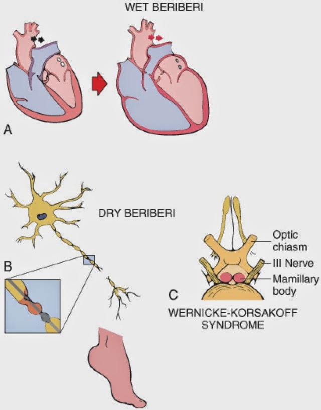 Hospitalist ~なんでも無い科医の勉強ノート~: Vitamin B1欠乏症: Wernicke脳症, Beri-beri ...