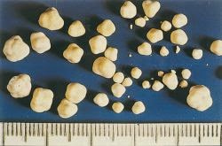 Health Education : Urolithiasis