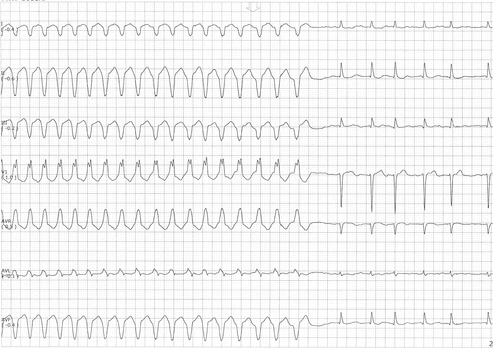 Ventricular Tachycardia
