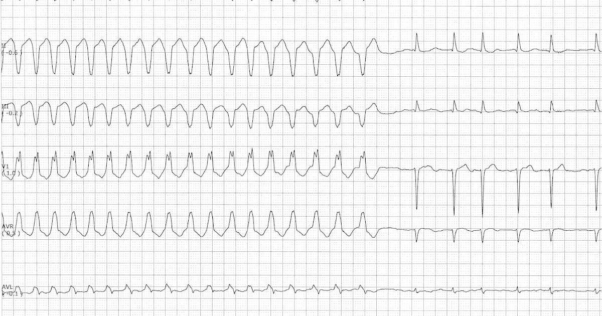 Ventricular Tachycardia