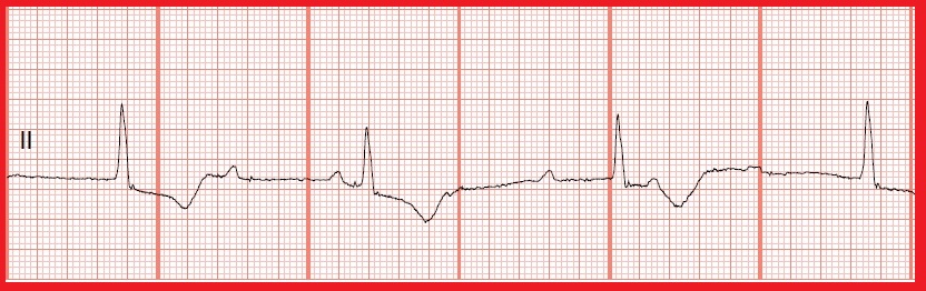 Practice EKG Rhythm Strips 191