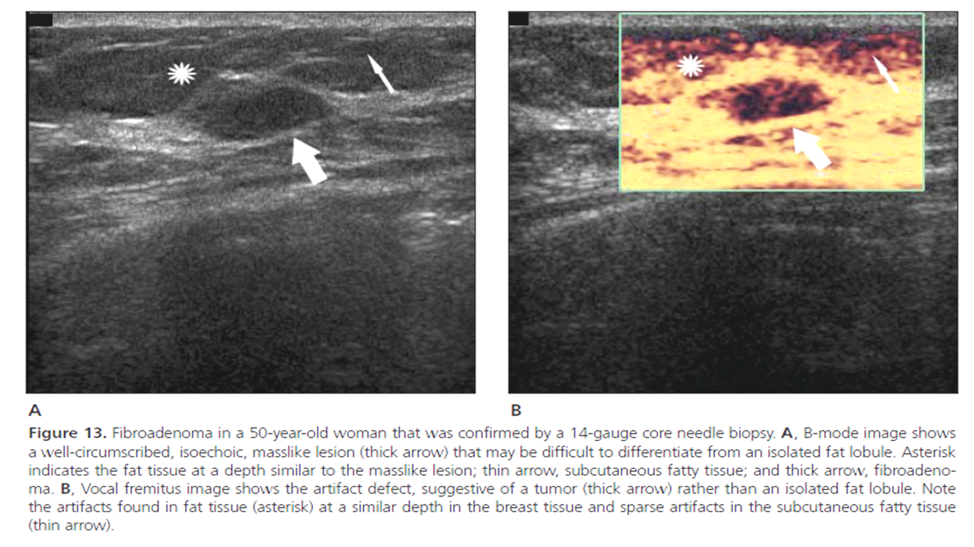 BÀI SOẠN VỀ SIÊU ÂM CHẨN ĐOÁN: VOCAL FREMITUS in BREAST COLOR ...