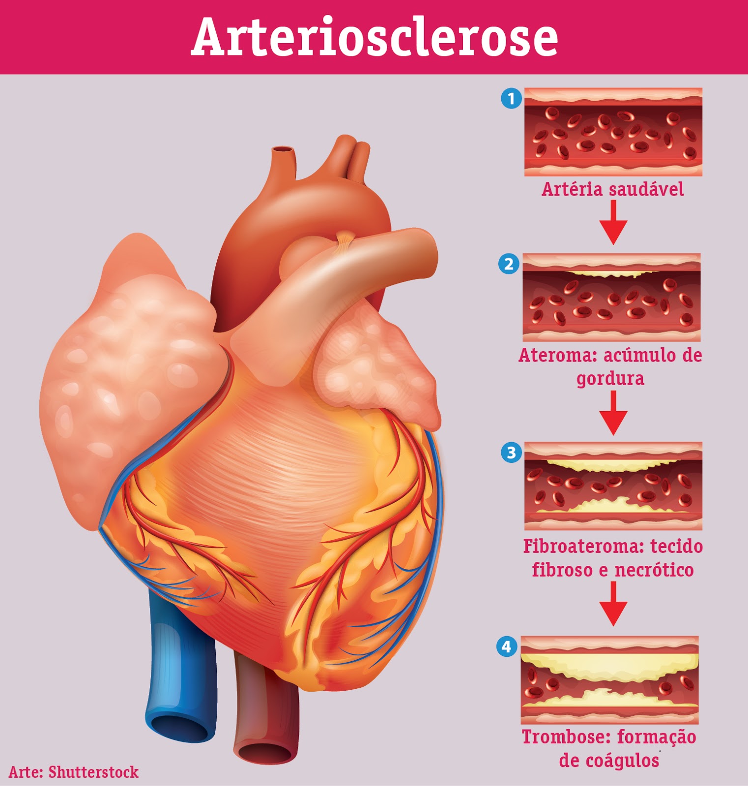 ATEROSCLEROSE E ARTERIOSCLEROSE. QUAL A DIFERENÇA? - Enfermagem por Amor