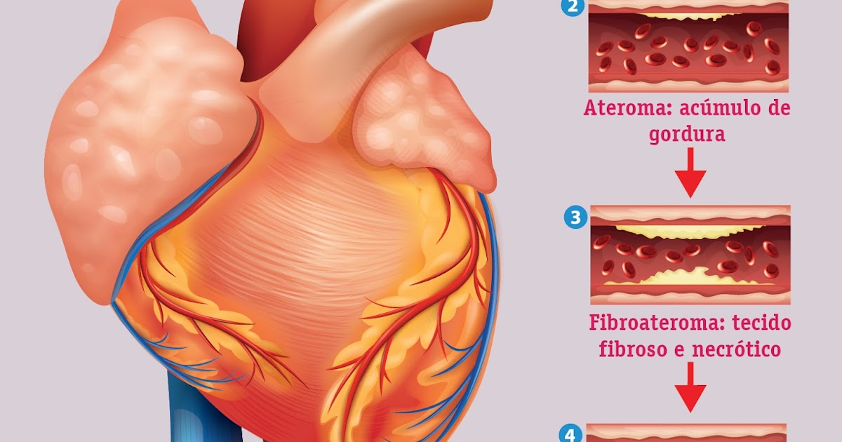 Arteriosclerose é Aterosclerose Diferença - RETOEDU
