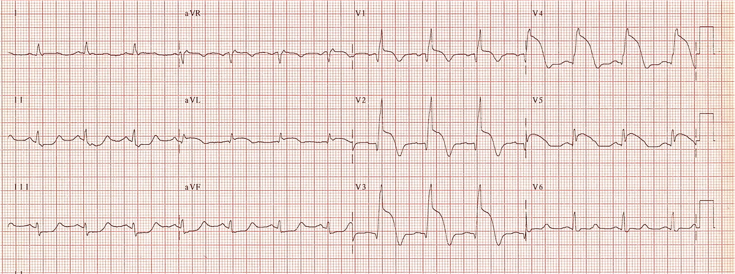 Anterior ST Elevation Myocardial Infarction | INA - ECG