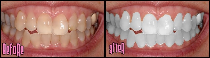 How To Easily Makes Your Teeth Shine? | My Indie Story