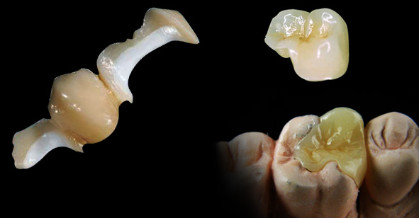 Restaurações dentais indiretas ( Inlay, Onlay, Crown - Overlay ...