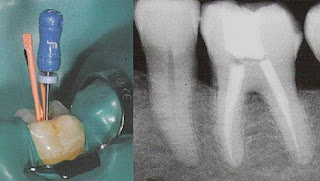 Endodontic: Endodontics: Part 1 The modern concept of root canal treatment