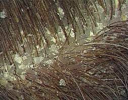 Ponto De Vista: Caspa Capilar, cuidados...