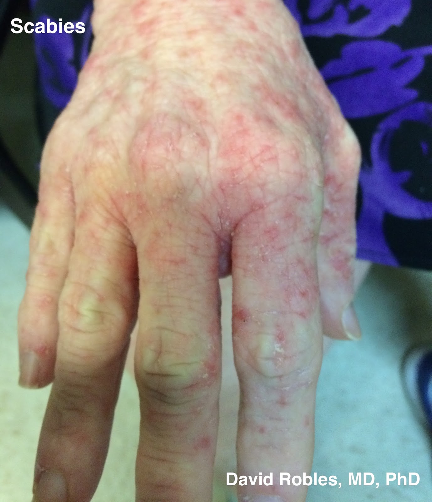 Scabies is a contagious disease: By David Robles, MD, PhD