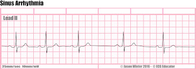 ECG Educator Blog : Sinus Arrhythmia