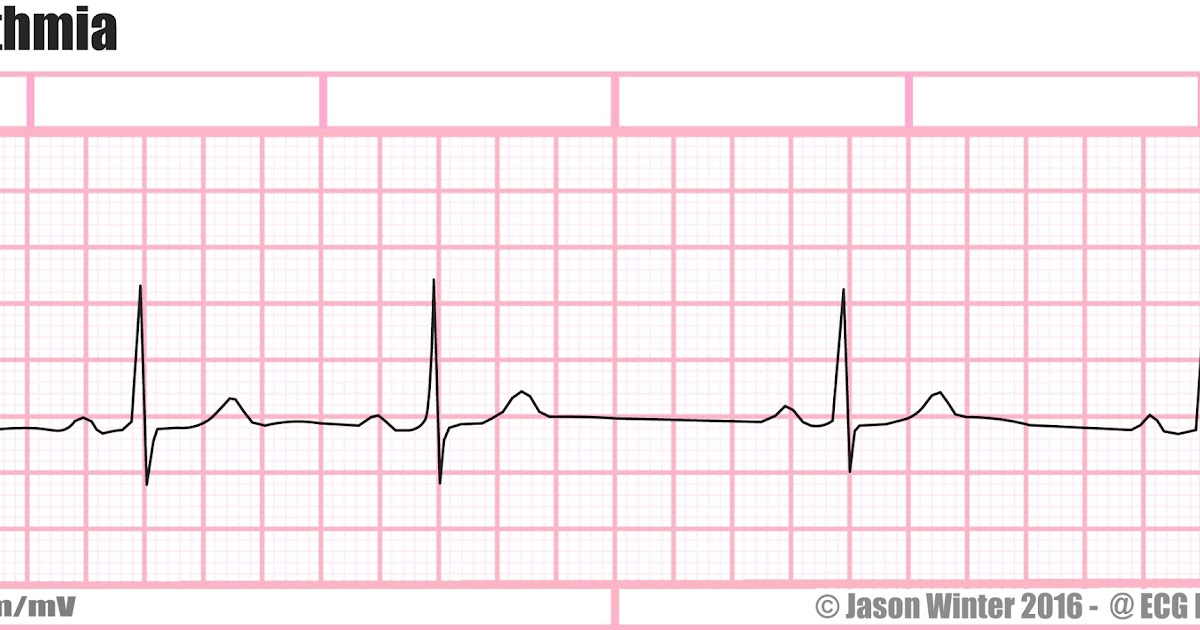 ECG Educator Blog : Sinus Arrhythmia