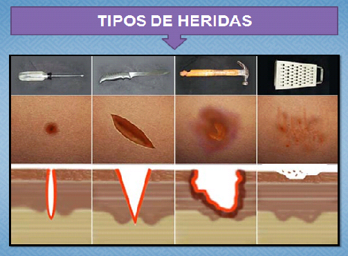 Hemorragias: concepto de heridas y tipos de heridas