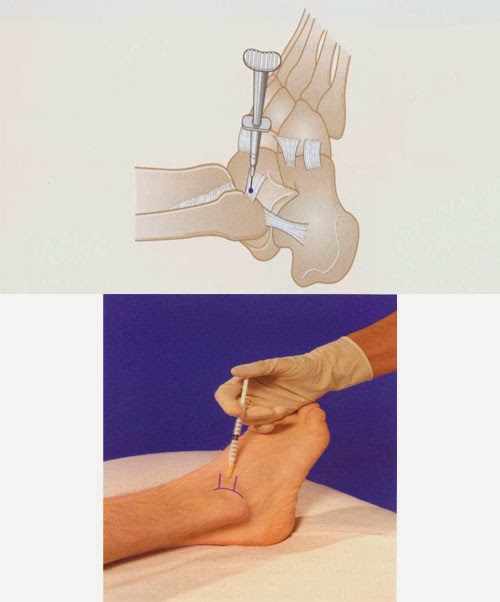 Lateral Ligament Injection ~ Nursing