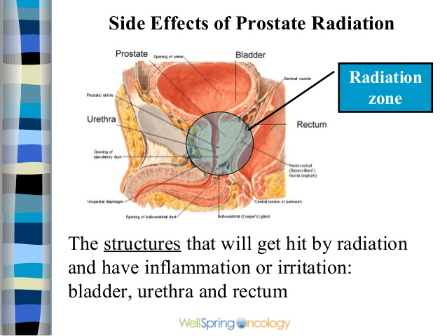My Trip On The You Have Advanced And Aggressive Prostate Cancer Hurry