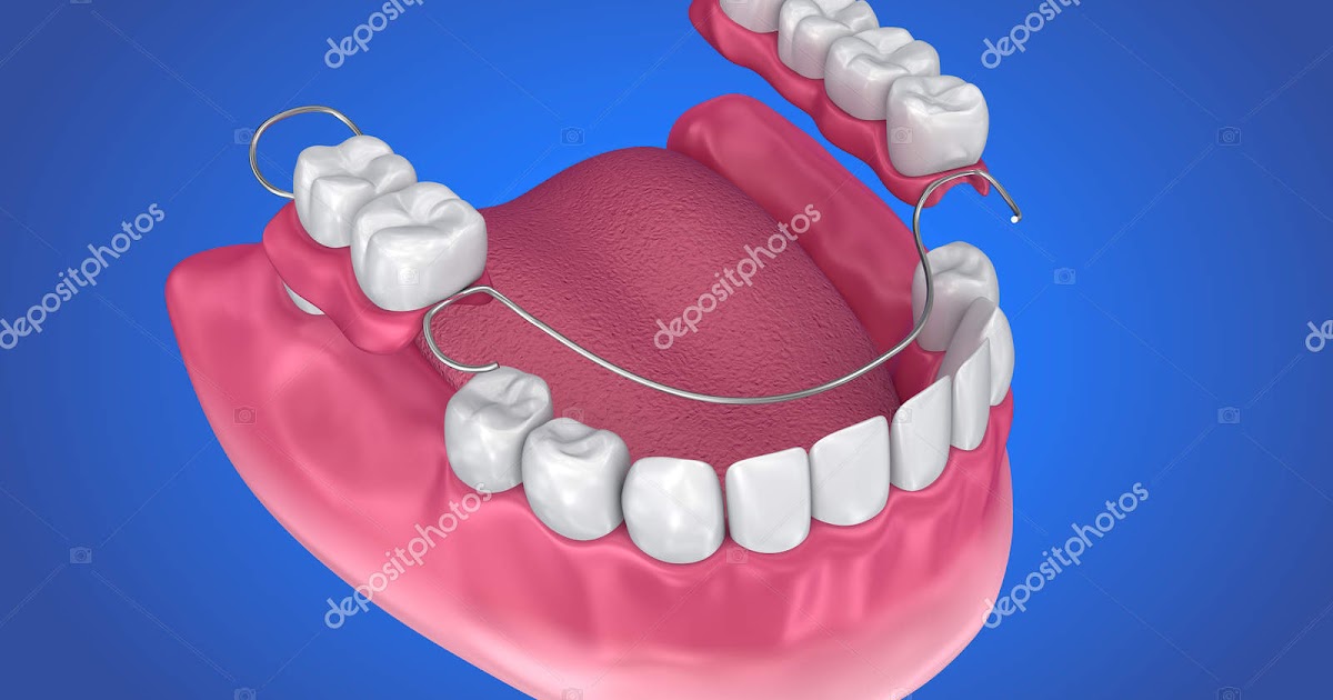 ASIKUY KUSI: ¿Qué es una prótesis parcial removible y qué tipos existen?