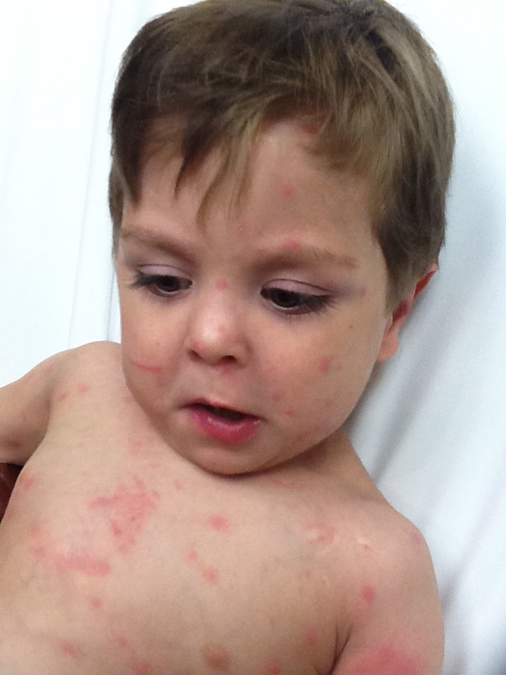 Carter Cates: Chicken Pox Scare...