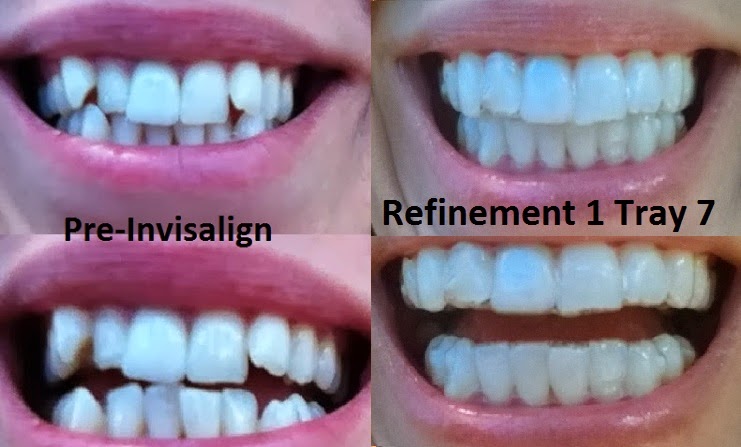 Michelle's Invisalign Journey: Refinement 1 Tray 7