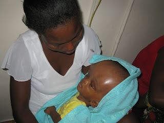 HAITI - CORAM DEO: photos - hydrocephalus - part 3