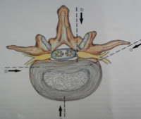 Endoscopic Spine Surgery: Why interlaminar?Why Destandau Techniques?