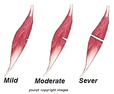 Your Physical Therapy: Physiotherapy for Muscles Strain